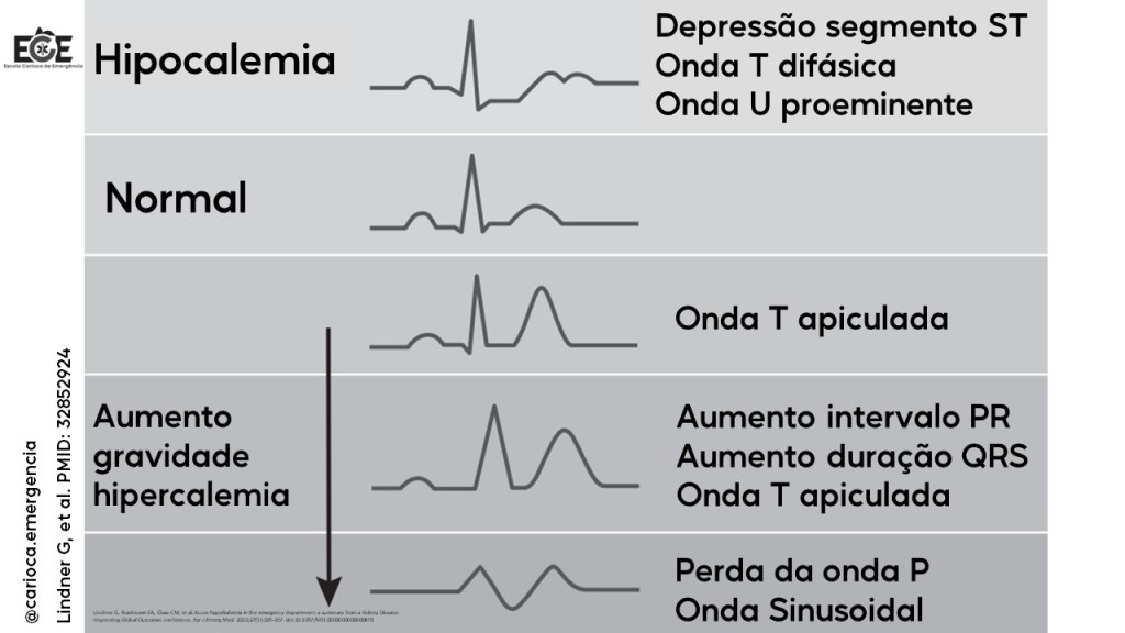 HiperKalemia / Hiperpotassemia – Escola Carioca de Emergência